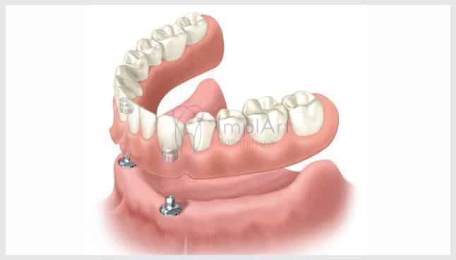 Prótese móvel para implantes - Overdenture - ImplArt Implantes